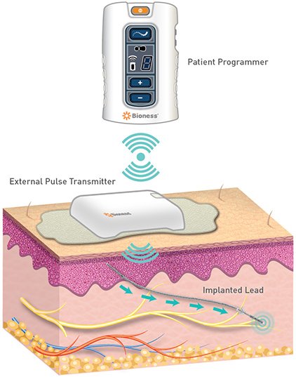 StimRouter | AFD Americas